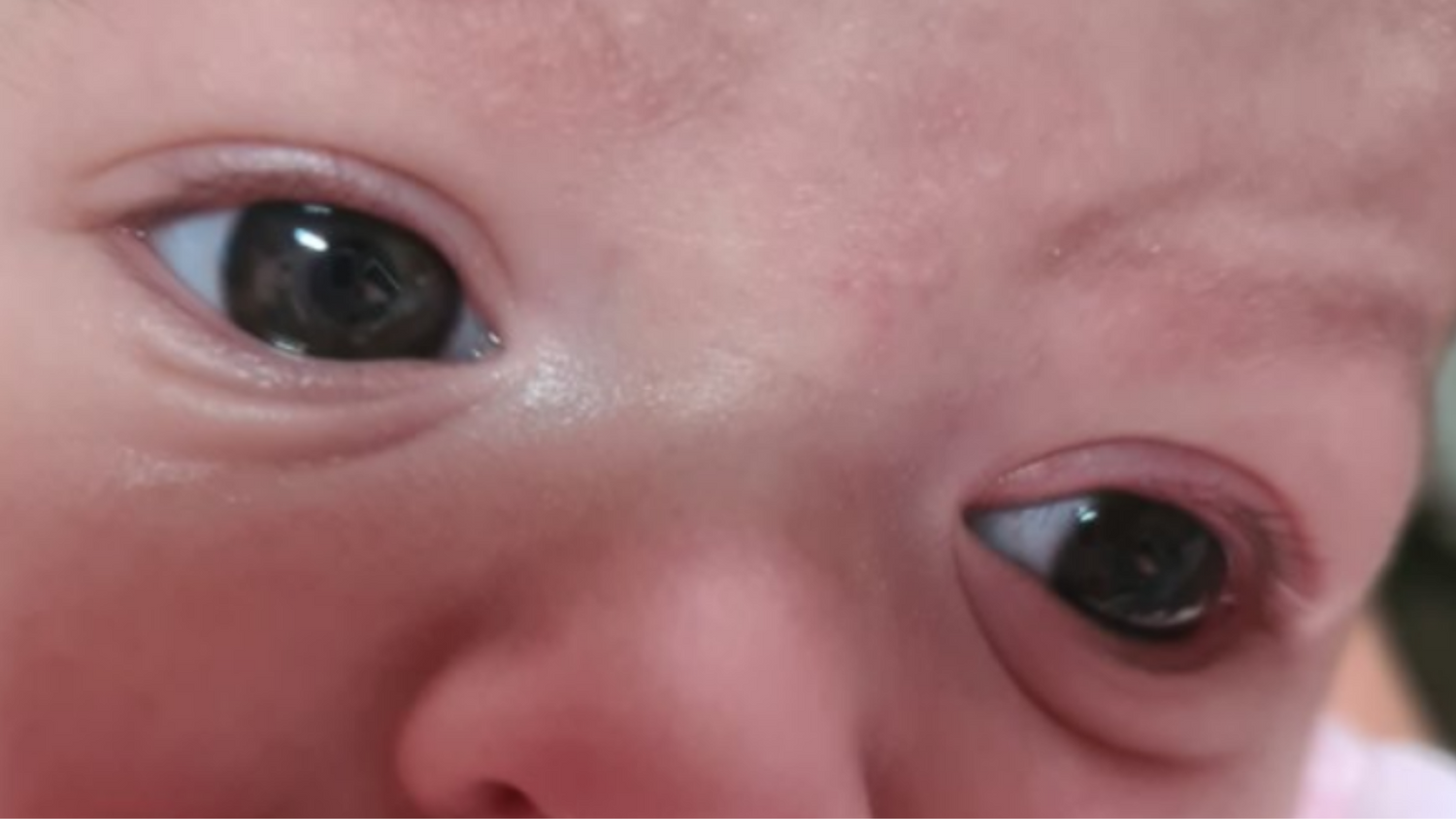 Bebê com a pálpebra inchada: Causas comuns e sinais de alerta – SunKids